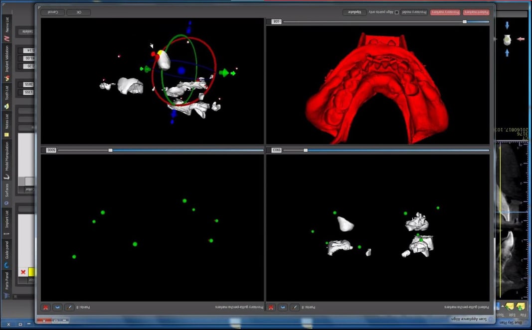 Creating a Surgical Guide with your CBCT
