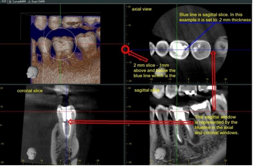 CBCT 201 - What is slice thickness and how varying it offers a ...