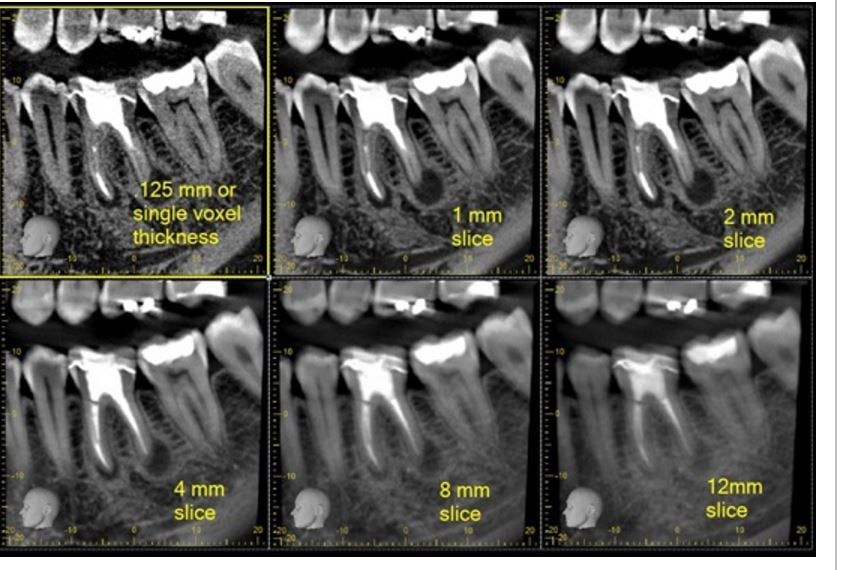 CBCT 201 - What is slice thickness and how varying it offers a ...